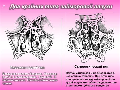 ОДОНТОГЕННЫЙ ГАЙМОРИТ Два крайних типа гайморовой пазухи Пневматический