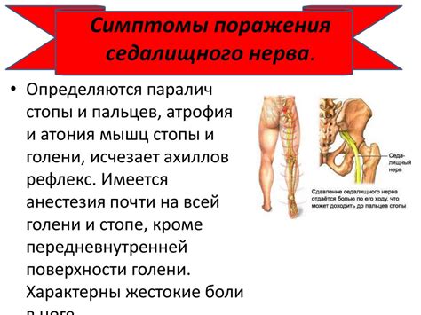 Лечение при защемлении нерва: Защемление седалищного нерва: симптомы и ...