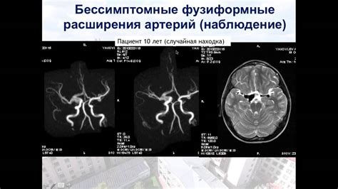 Нейрохирургия - Аневризмы головного мозга у детей - YouTube