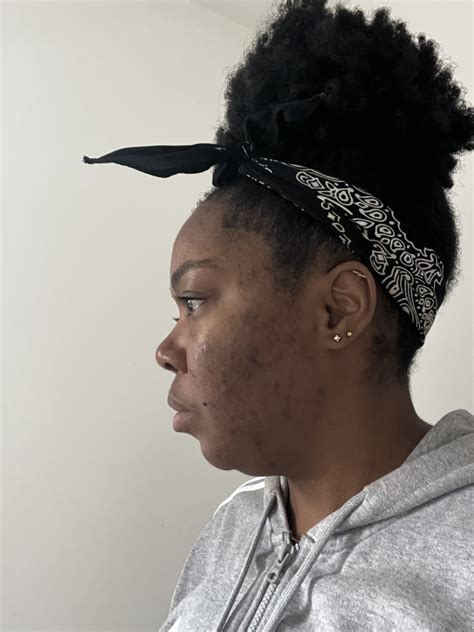 Dermatica Review & Experience [My Dermatica Diaries] - keep it simpElle