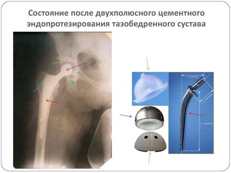 Повреждение бедра - презентация онлайн
