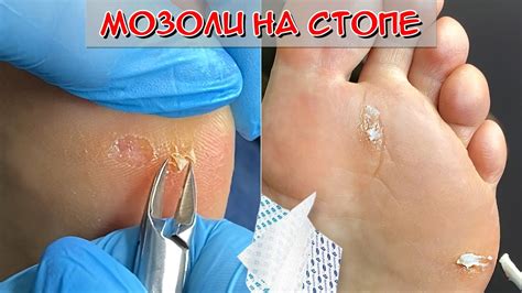 Стрежневая мозоль удаление / Мозоль на стопе - YouTube