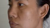 Freckles And Spot Melasma Pigmentation Skin Facial Treatment Over Asian Woman Face Stock Video ...