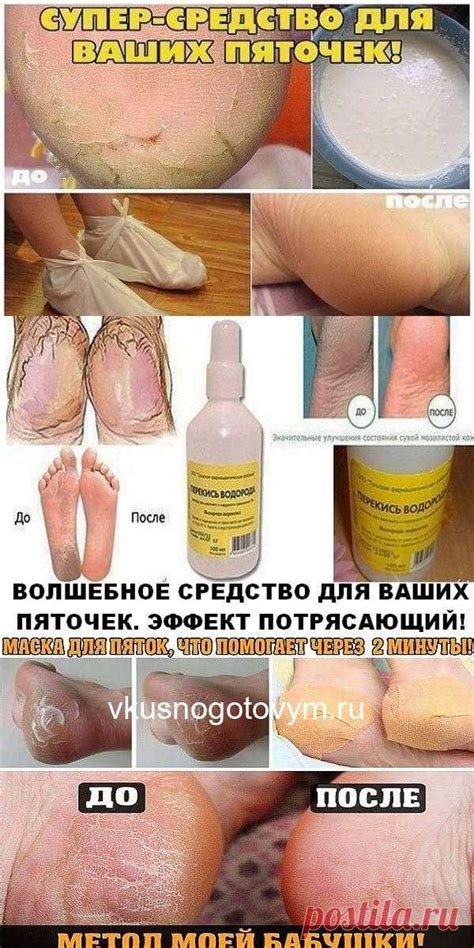 ВОЛШЕБНОЕ СРЕДСТВО ДЛЯ ВАШИХ ПЯТОЧЕК. ЭФФЕКТ ПОТРЯСАЮЩИЙ! | Полезные ...