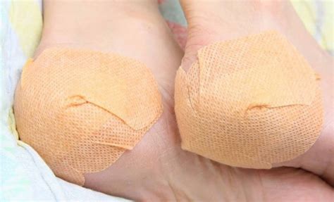 Рентгенотерапия при пяточной шпоре, где делают и отзывы о лечении