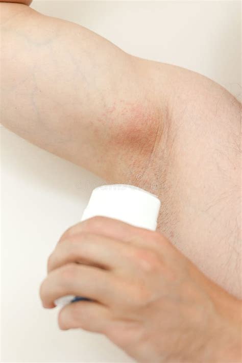 Cropped Photo of Irritation, Inflammation on Sensitive Underarm Skin after Using Toxic Deodorant ...