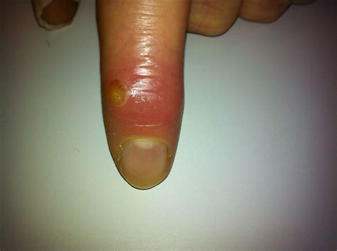 Heberden (1) - DocCheck