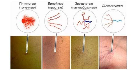 Сосудистые звездочки на ногах: причины и лечение