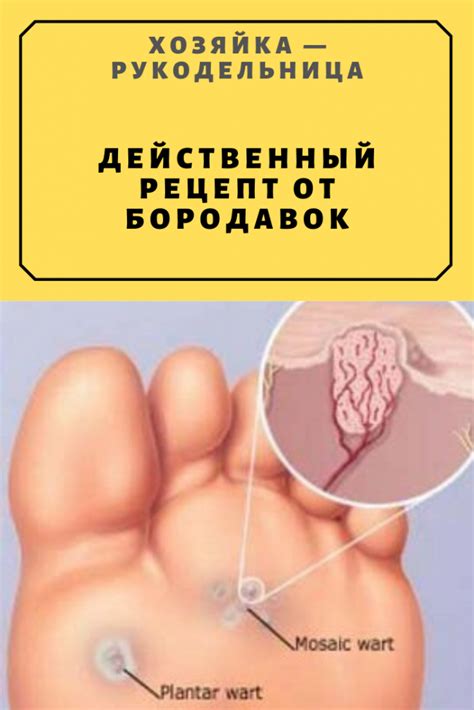 Действенный рецепт от бородавок — Хозяйка — Рукодельница