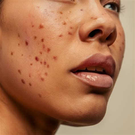CloseUp of a Womans Face with Acne Skincare Tips and Solutions Understanding Acne on Womens Fac ...