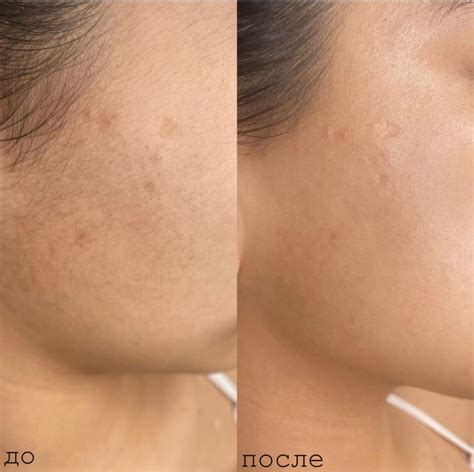 Обучение процедуре Dermaplaning - Дермапланинг: официальный сайт
