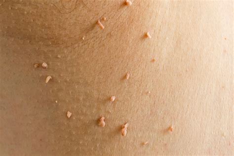 Skin Tags | REJUVA Dermatology and Vein Center
