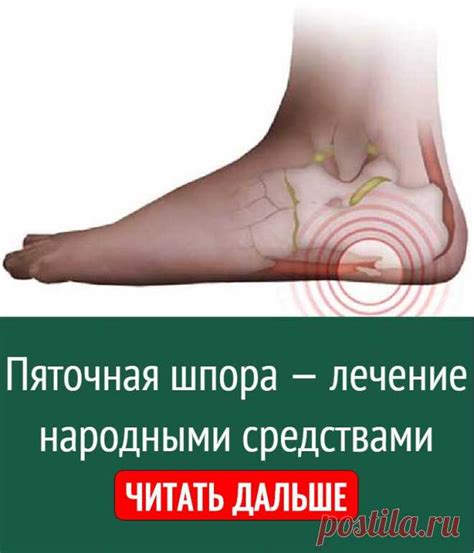 Пяточная шпора — лечение народными средствами | Полезные советы | Постила
