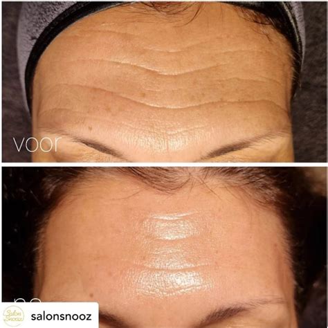 KRX Carboxy terápia - CO2 | LONDON BEAUTY PRO.