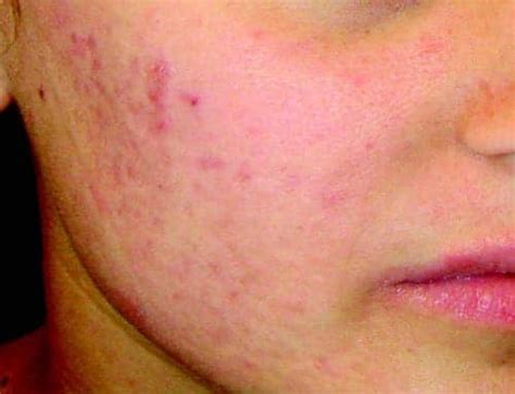 Top Acne Scar Treatment NYC - Dermatology & Laser Group