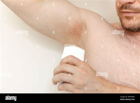 Rash Armpit
