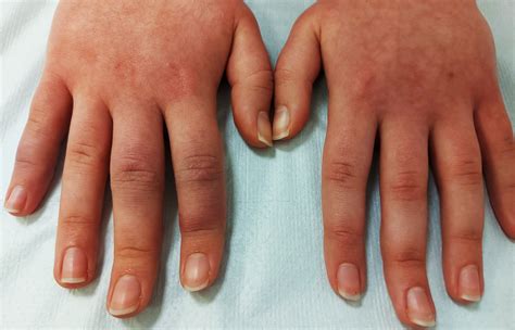 Livedo Reticularis Hands