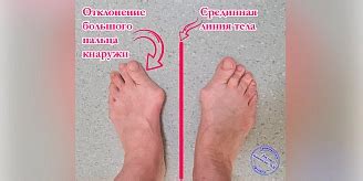 Как избавиться от косточки на ноге у большого пальца?