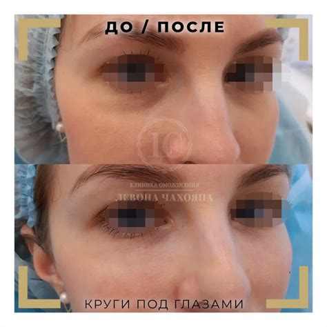 Мешки под глазами: причины, лечение и профилактика у женщин после 50 ...