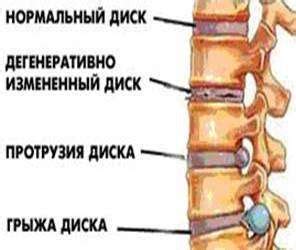 Протрузия межпозвоночного диска: симптомы и лечение
