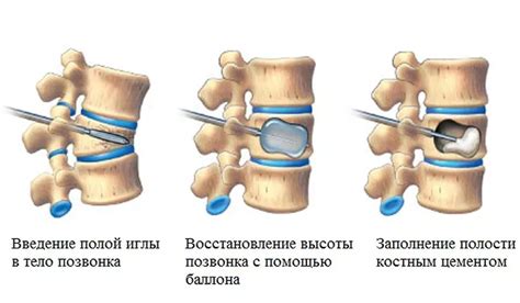 Вертебропластика позвоночника: что такое, показания и проведение
