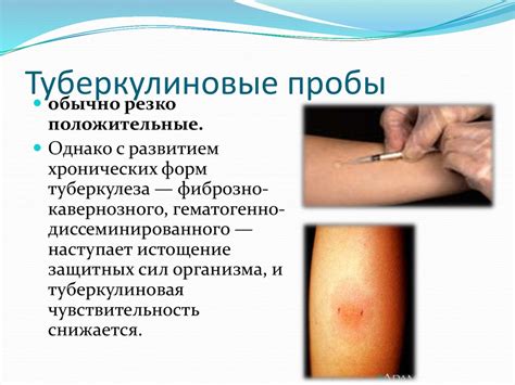 Туберкулез и сахарный диабет: лечение, симптомы, профилактика и прогноз
