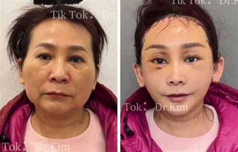 A Plastic Surgeon Goes Viral for His Transformation Videos / Bright Side