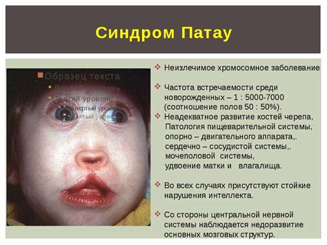 Синдром Патау фото