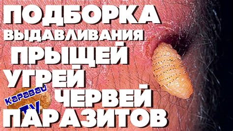 КАРАВАЙTV / ПОДБОРКА ВЫДАВЛИВАНИЯ ПРЫЩЕЙ / УГРЕЙ / ПАРАЗИТОВ / ЧЕРВЕЙ ...