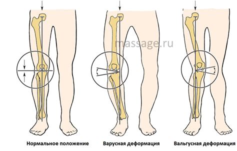 Надколенно-бедренный сустав | Массаж.ру