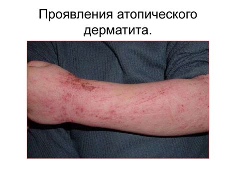 Атопический дерматит - презентация онлайн