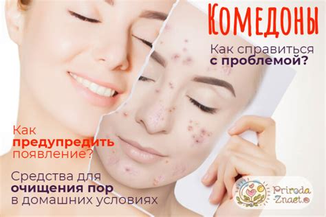 Комедоны – лечение медикаментозными и домашними средствами