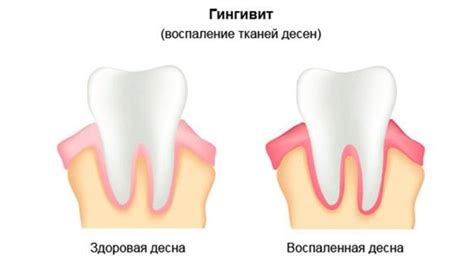 Причины и методы лечения повышенного слюноотделения | стоматологическая ...
