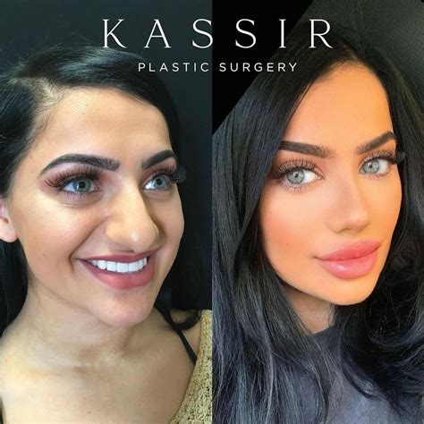 Pin on Rhinoplasty Dallas