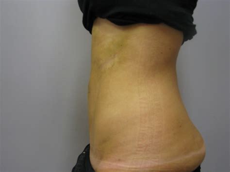 Selston Cosmetic Clinic: Female Abdo..Vaser Lipo Before and After