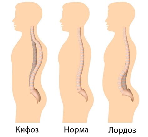 Гиперлордоз поясничного отдела позвоночника: упражнения для лечения и ...