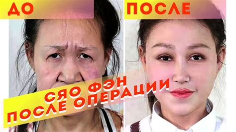 СЯО ФЭН ПОСЛЕ ОПЕРАЦИИ - YouTube