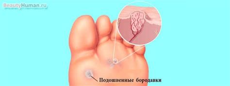 Видалення бородавок на стопі в Києві. Академія подології Конева 👨‍⚕️