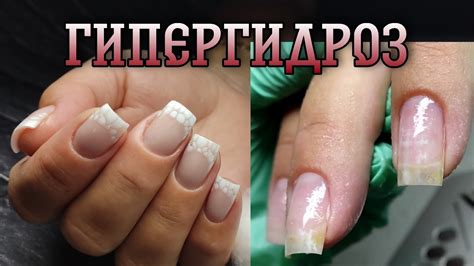😲гипергидроз!!! френч-растекашка☺💅 - YouTube