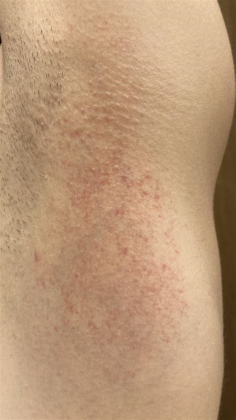Armpit rash? : r/DermatologyQuestions