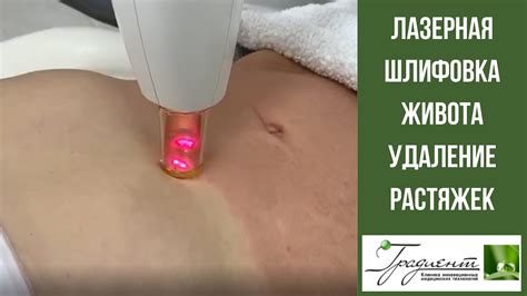 ЛАЗЕРНАЯ ШЛИФОВКА ЖИВОТА. Удаление растяжек, подтяжка кожи. - YouTube