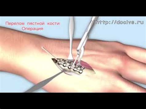 Перелом пястной кости. Операция - YouTube
