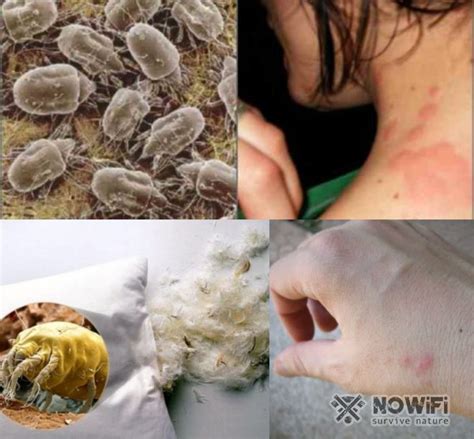 Как выглядит укус клеща: фото, признаки и что при этом делать